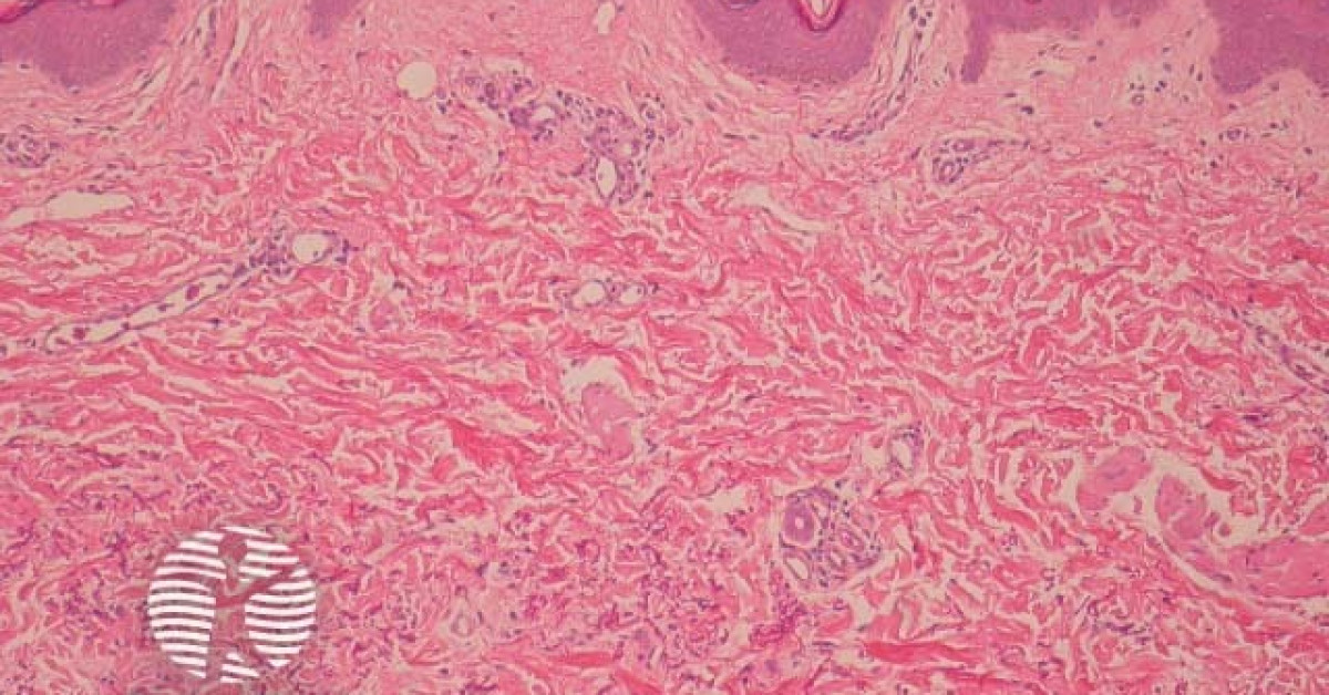 Pseudoxanthoma Elasticum Pathology Image