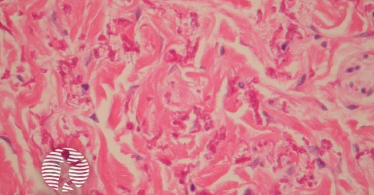 Dermnet® Pseudoxanthoma Elasticum Pathology Image