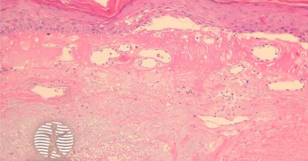 Radiation dermatitis pathology image