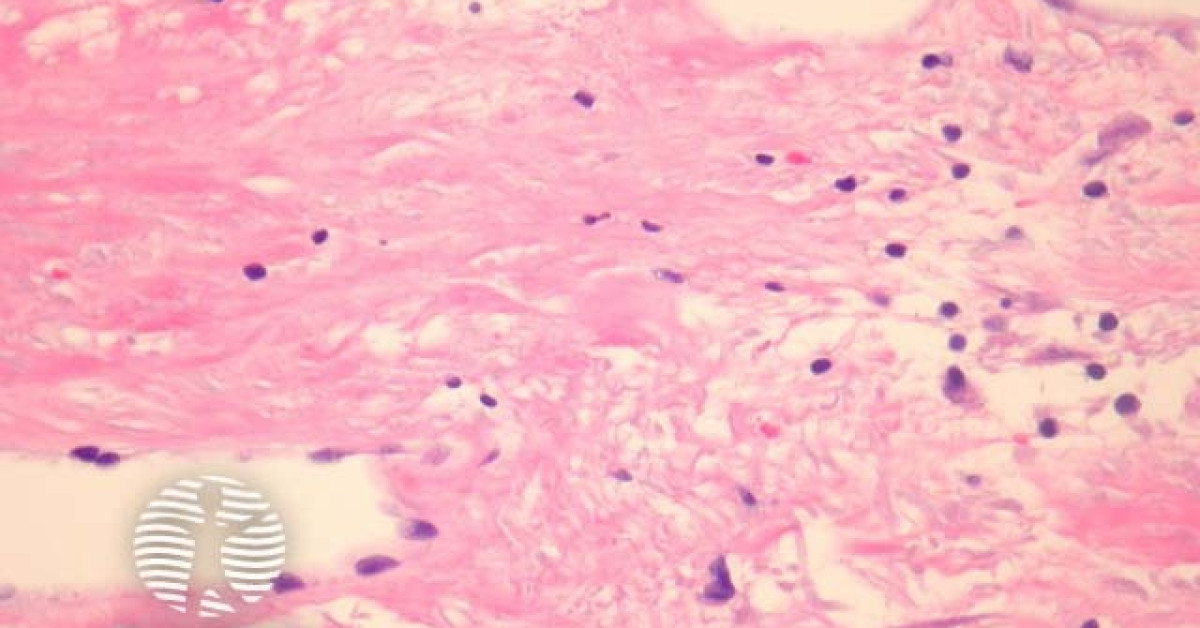 Radiation dermatitis pathology image