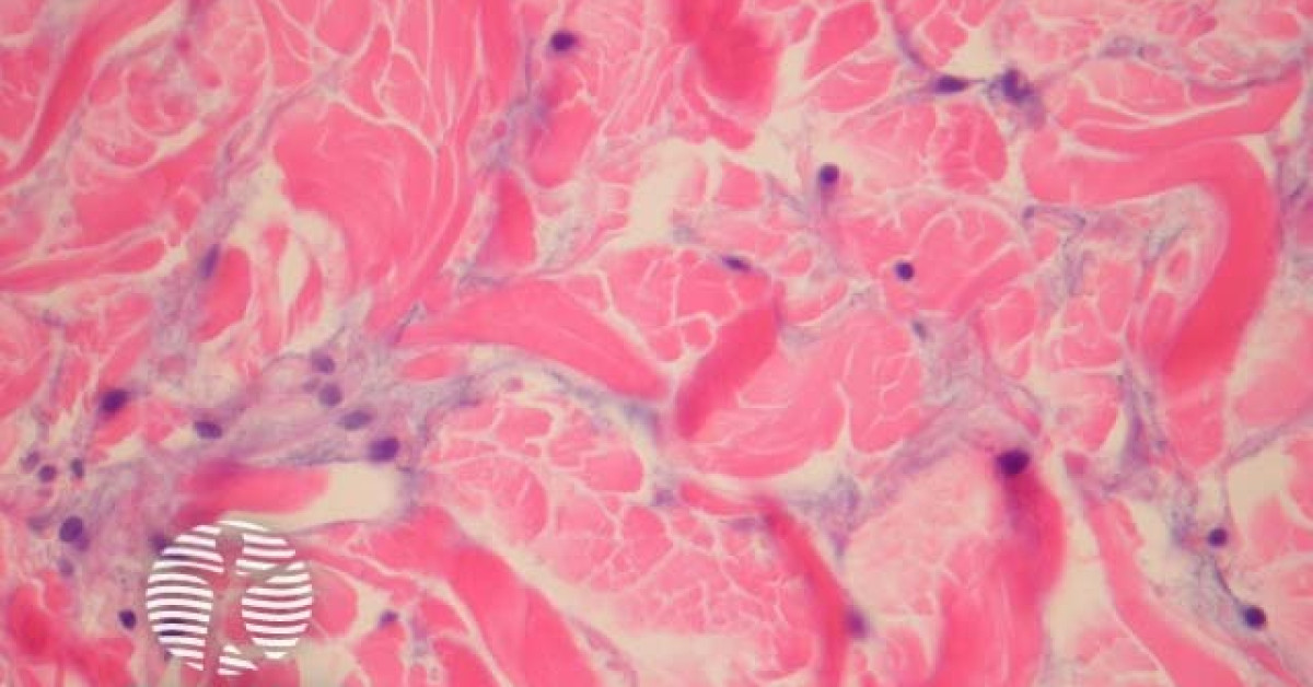 Reticular Erythematous Mucinosis pathology image