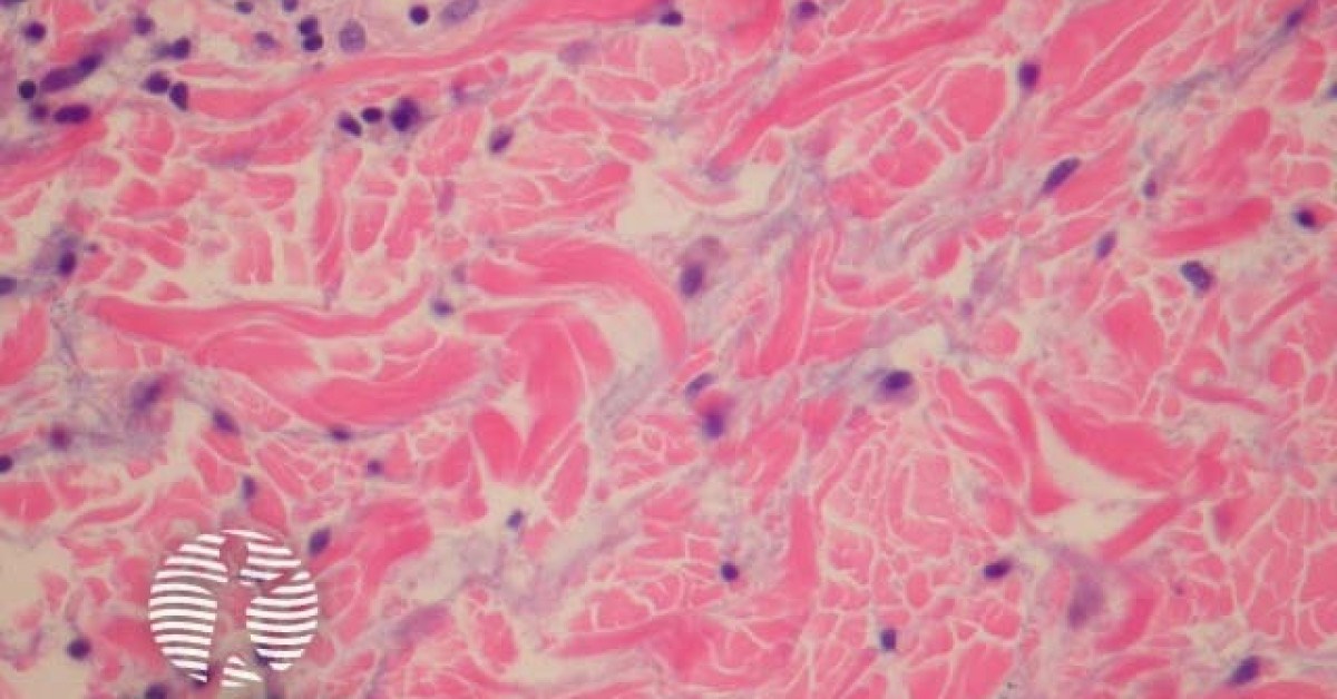 Reticular Erythematous Mucinosis pathology image