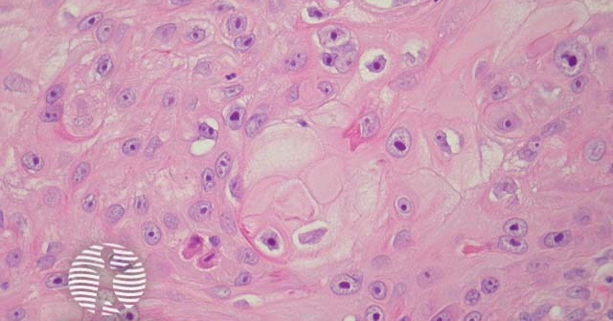 Squamous cell carcinoma pathology image