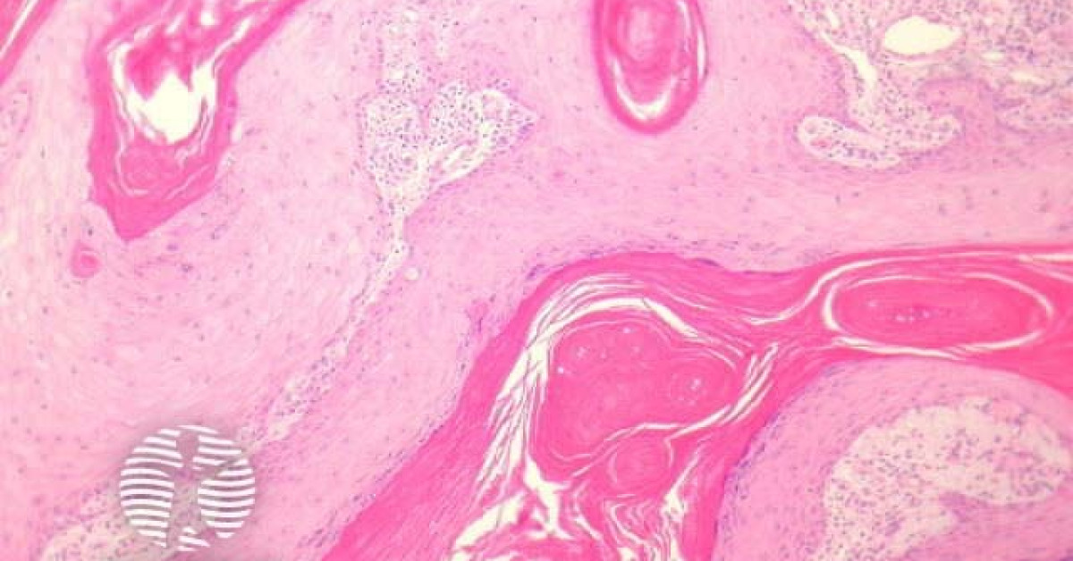 Well differentiated squamous cell carcinoma pathology image