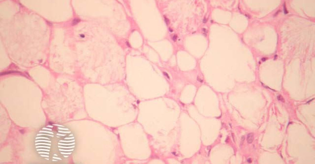 Sclerema neonatorum pathology image