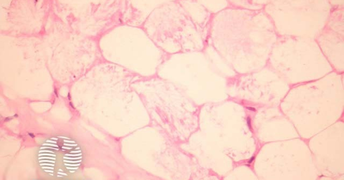 Sclerema neonatorum pathology image