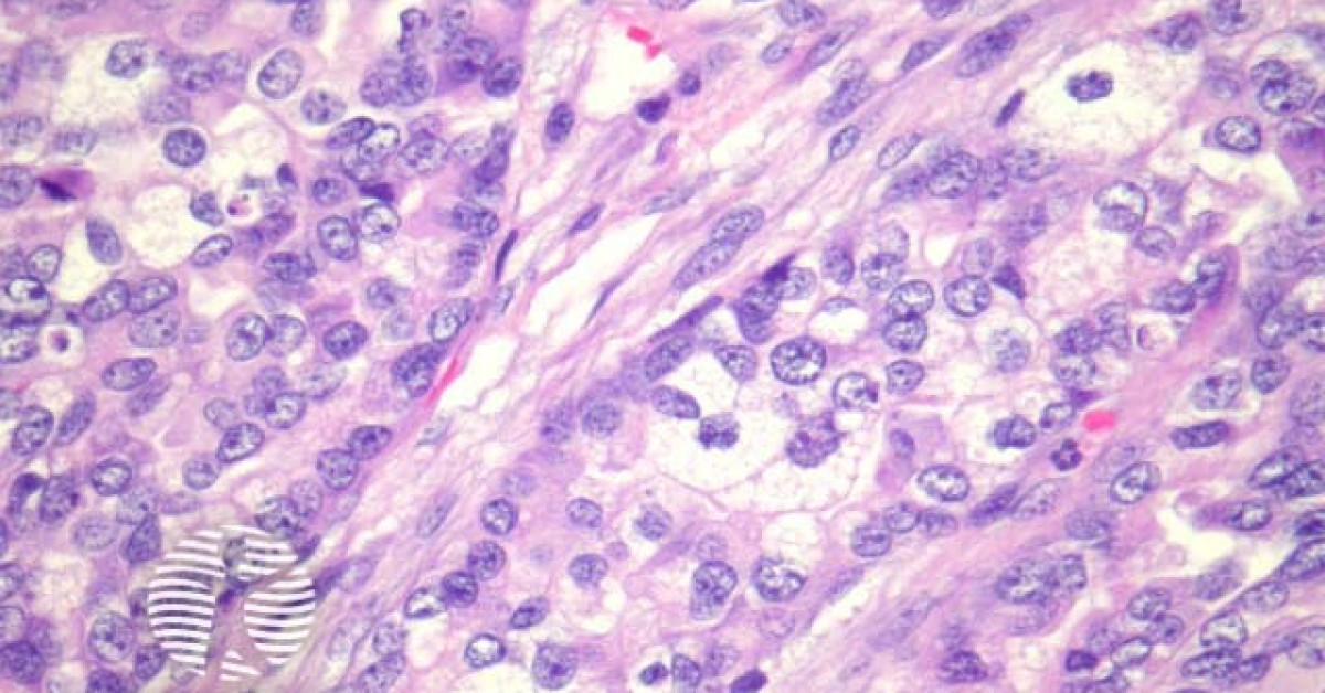 Sebaceous carcinoma pathology image