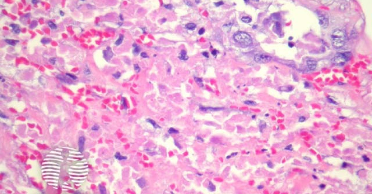 Sebaceous carcinoma pathology image