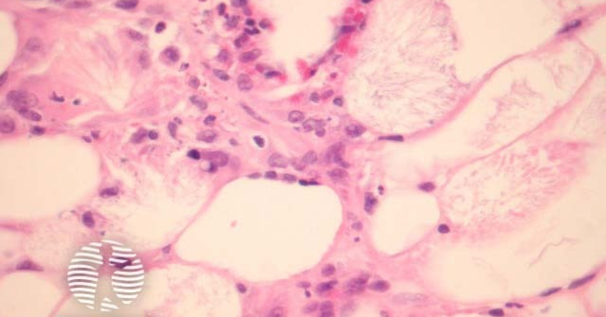Subcutaneous fat necrosis of the newborn pathology image