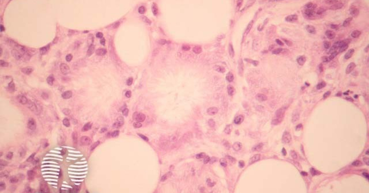Subcutaneous fat necrosis of the newborn pathology image