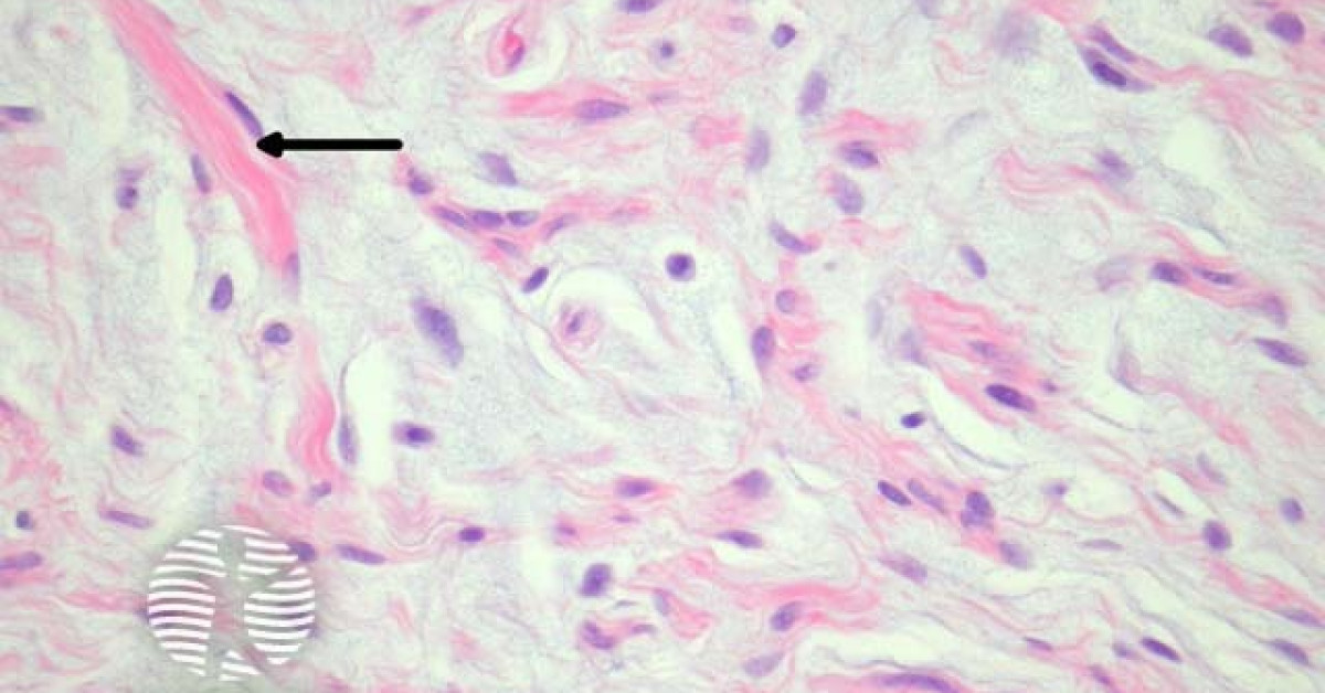 Spindle cell lipoma pathology image