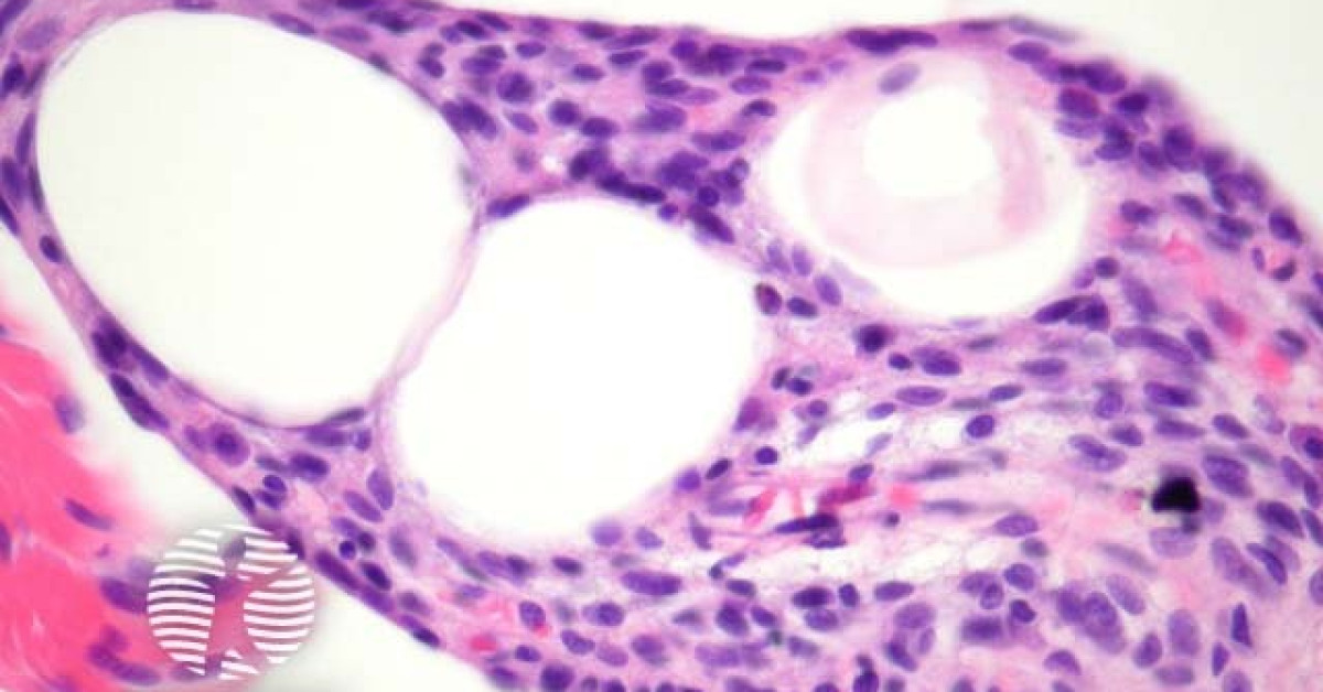 Spindle cell lipoma pathology image