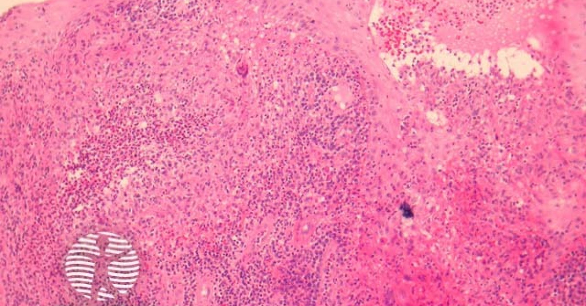 Sporotrichosis pathology image