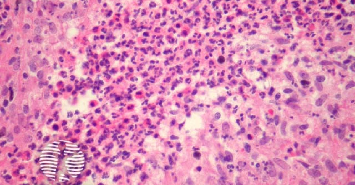 Sporotrichosis pathology image