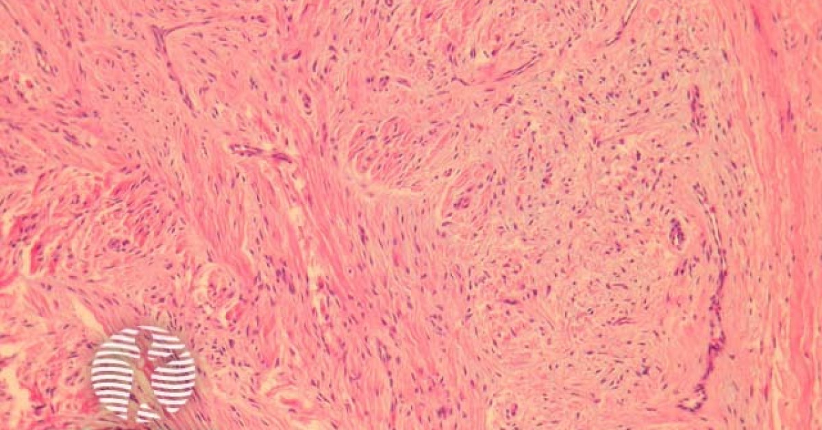 Superficial acral fibromyxoma pathology image