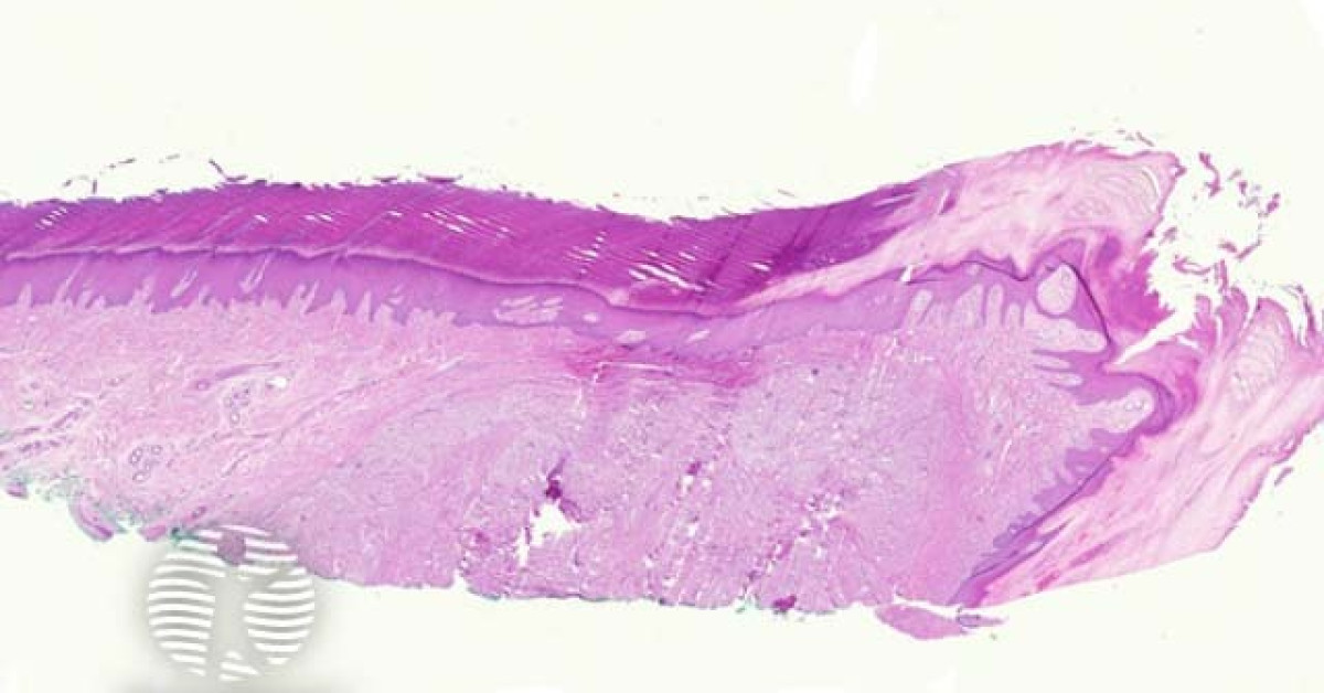 Superficial acral fibromyxoma pathology image