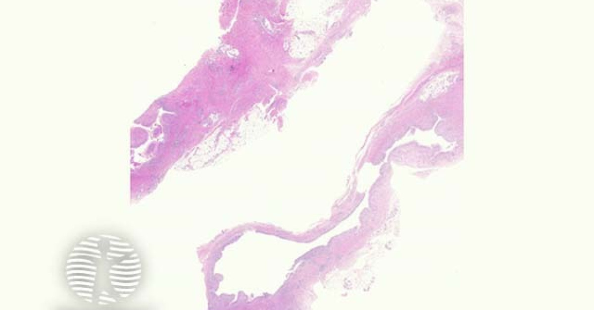 Synovial metaplasia pathology image