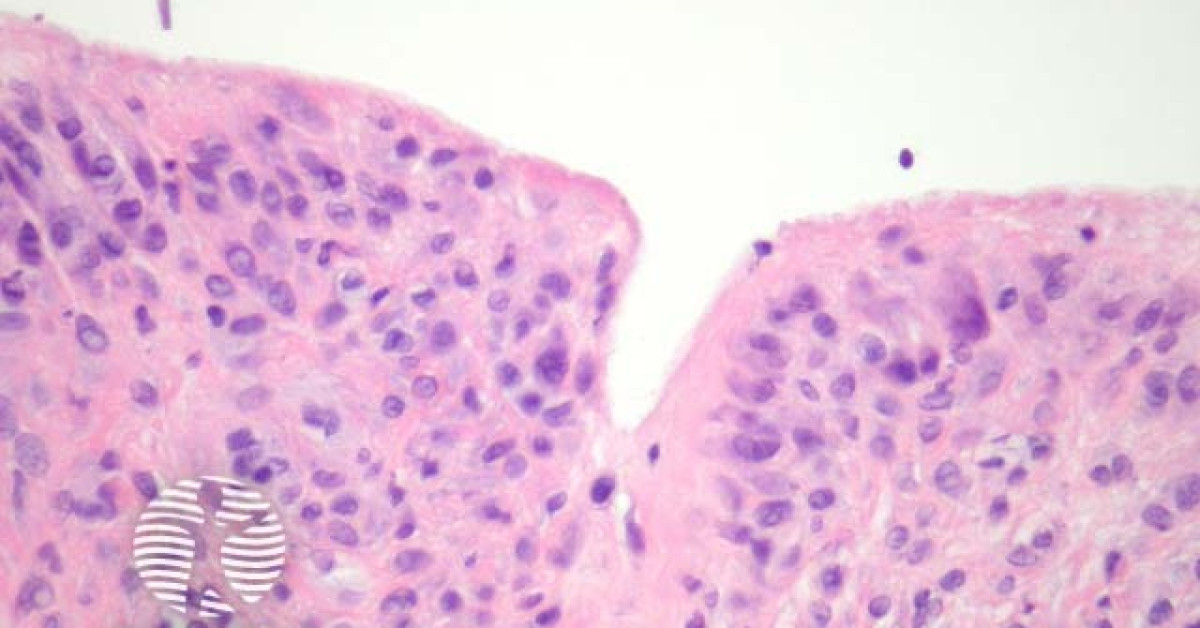 Synovial metaplasia pathology image