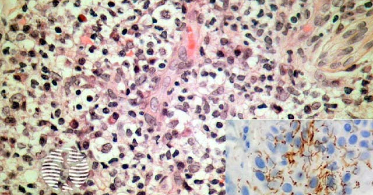 Syphilis pathology image