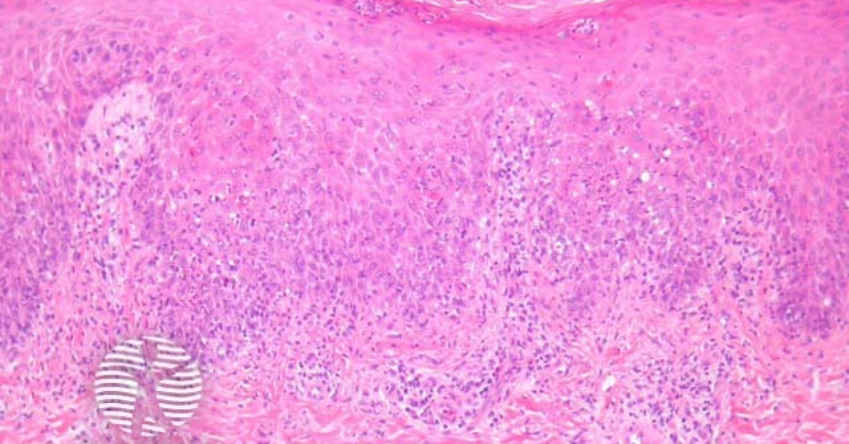 Syphilis pathology image
