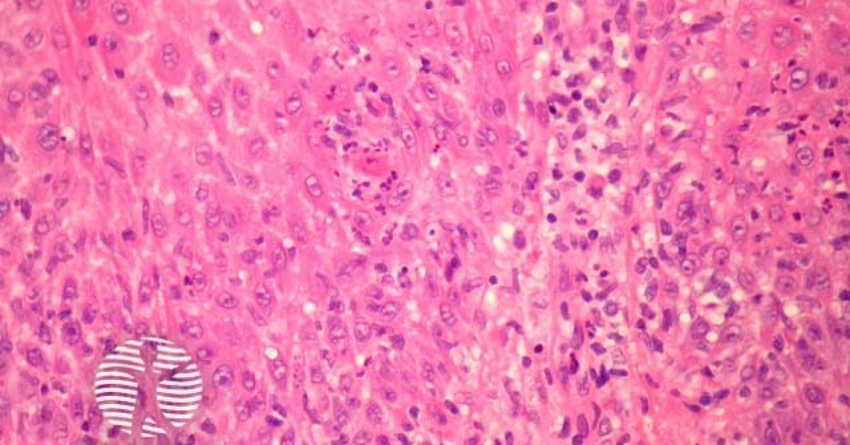 Syphilis pathology image