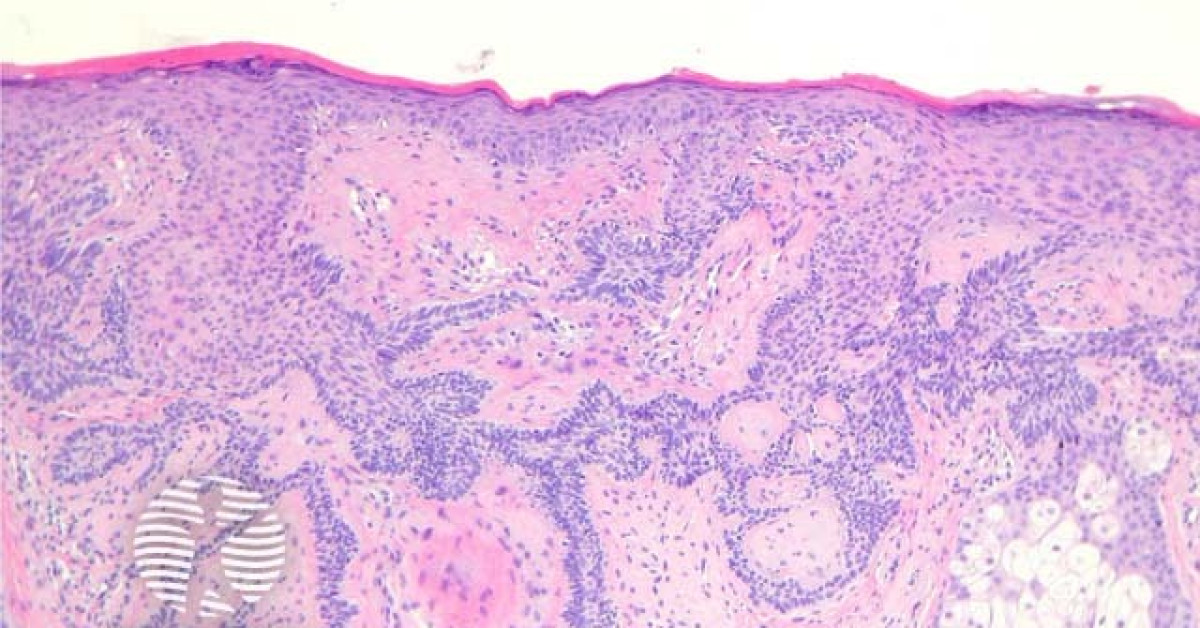 Tumour of the follicular infundibulum pathology image