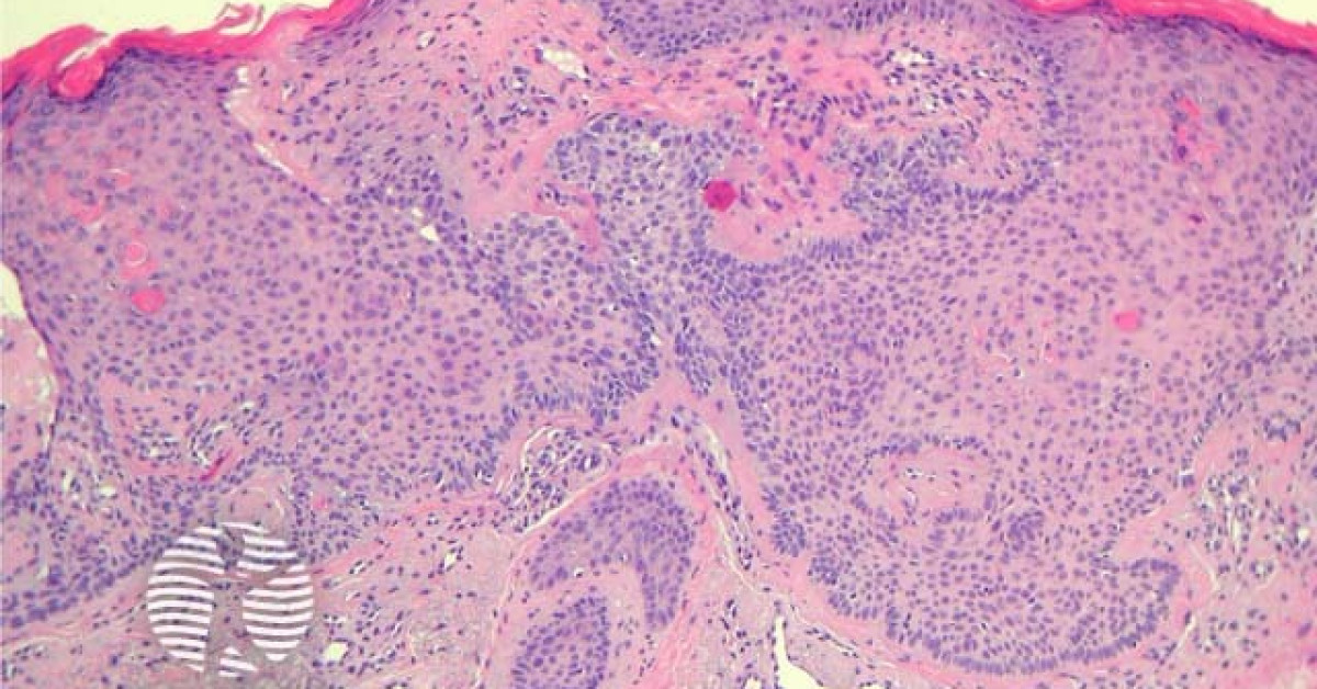 Tumour of the follicular infundibulum pathology image