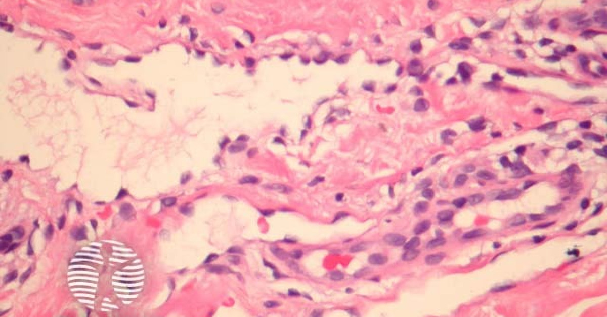 Targetoid haemosiderotic haemangioma pathology image