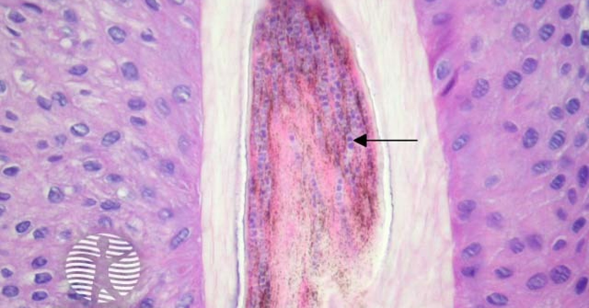 Tinea capitis pathology image