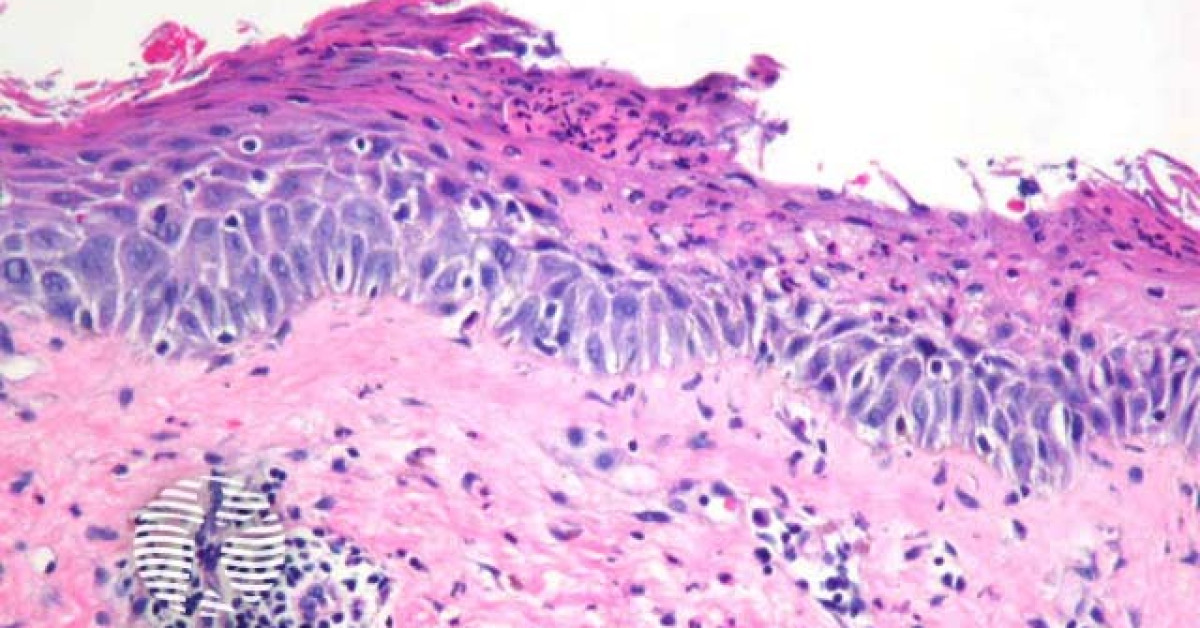 Tinea corporis pathology image
