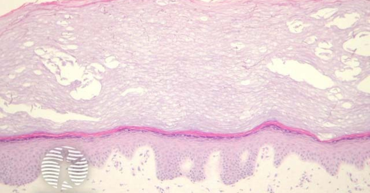 Tinea nigra pathology image