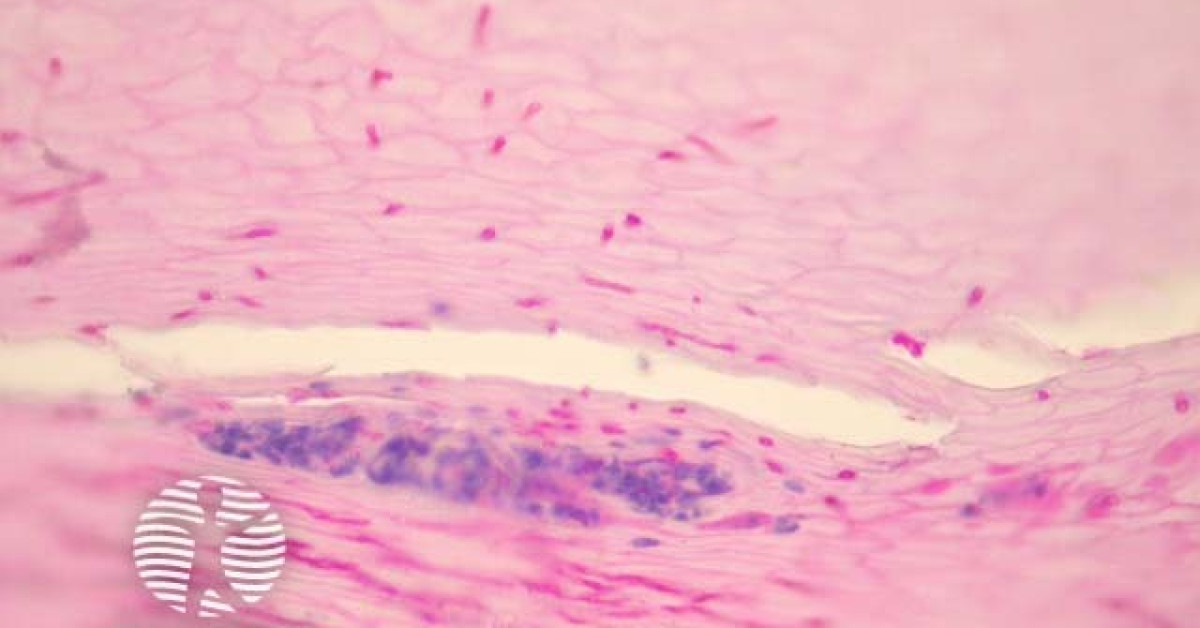 Onychomycosis pathology image