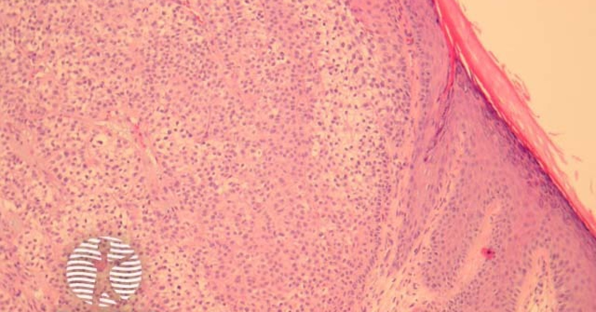Trichilemmal carcinoma pathology image