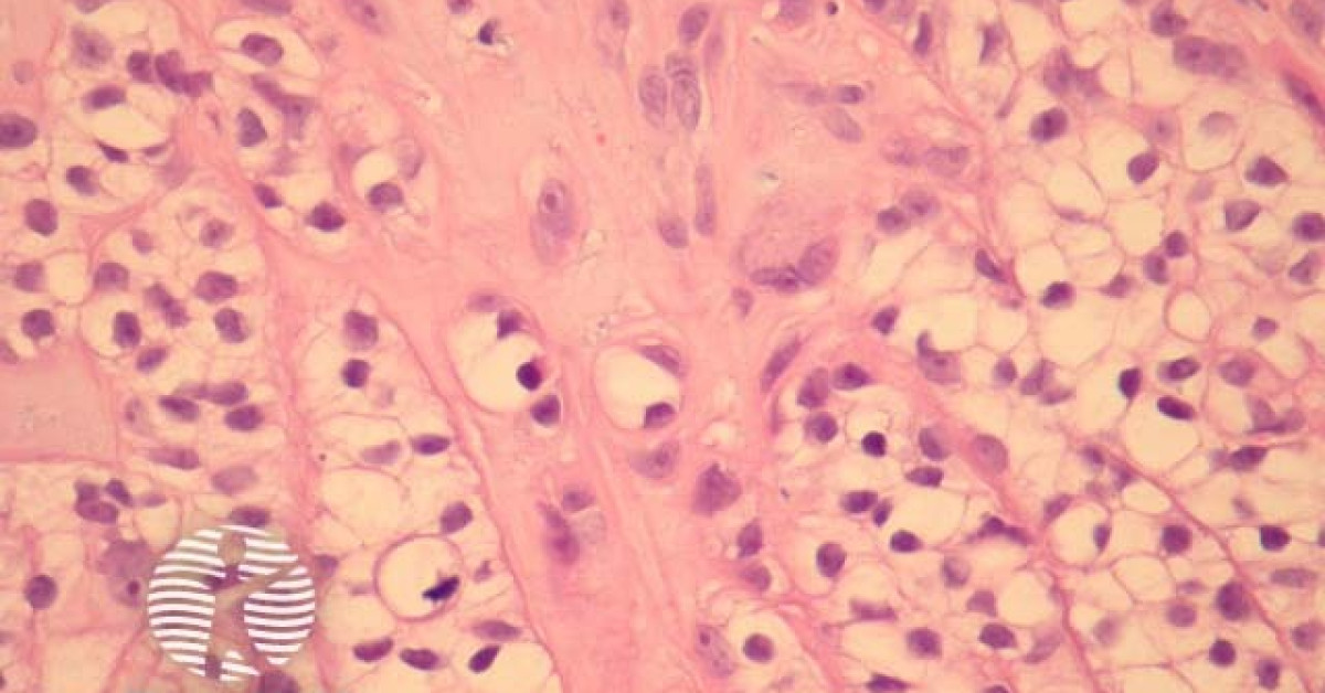 Trichilemmal carcinoma pathology image