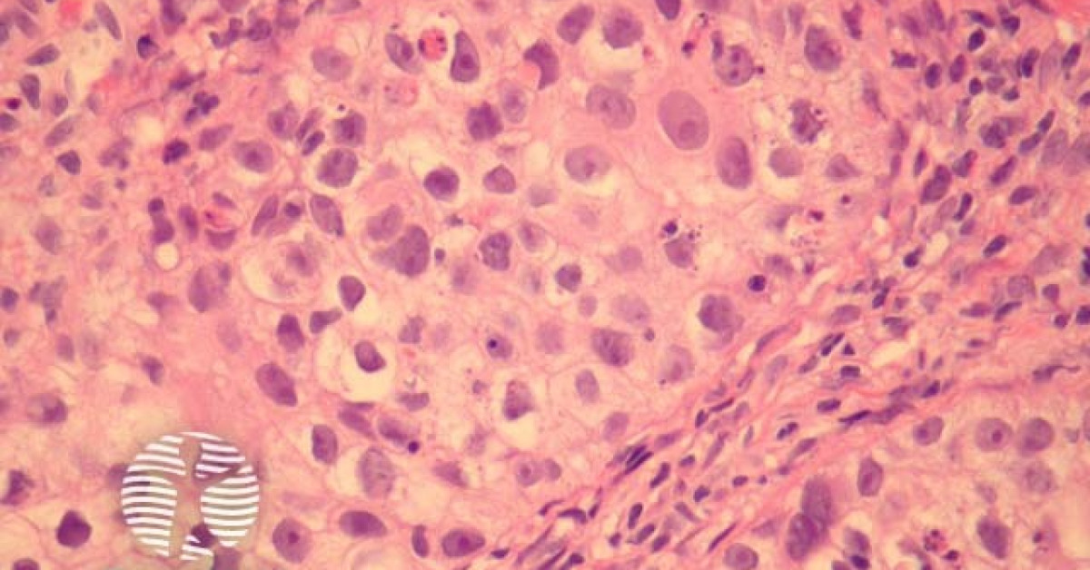 Trichilemmal carcinoma pathology image