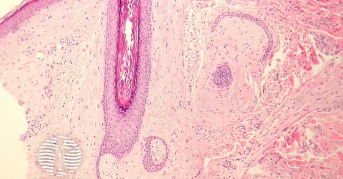 Fibrofolliculoma / trichodiscoma pathology image