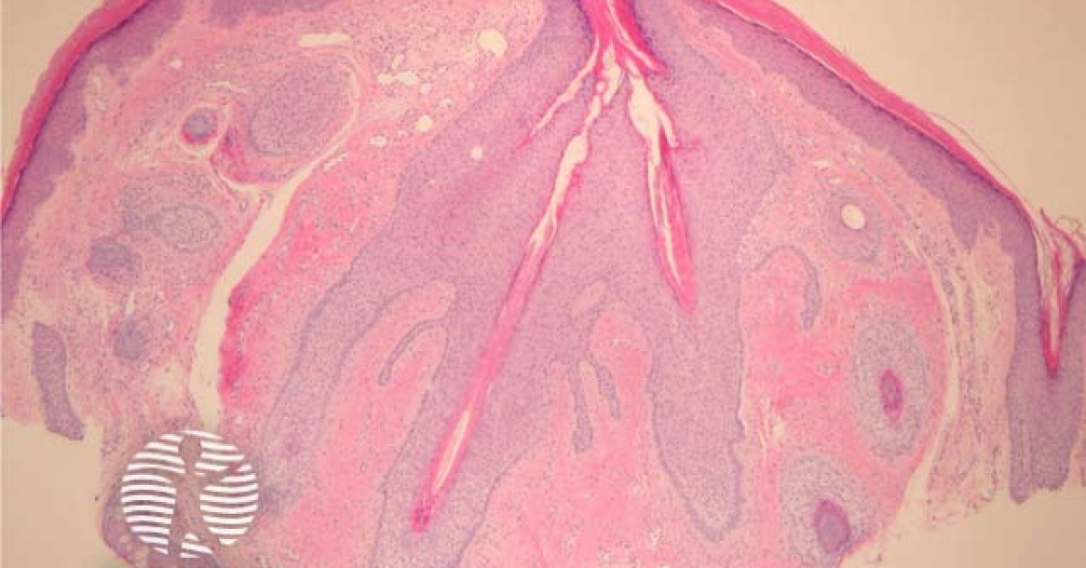 Trichofolliculoma / trichodiscoma pathology image