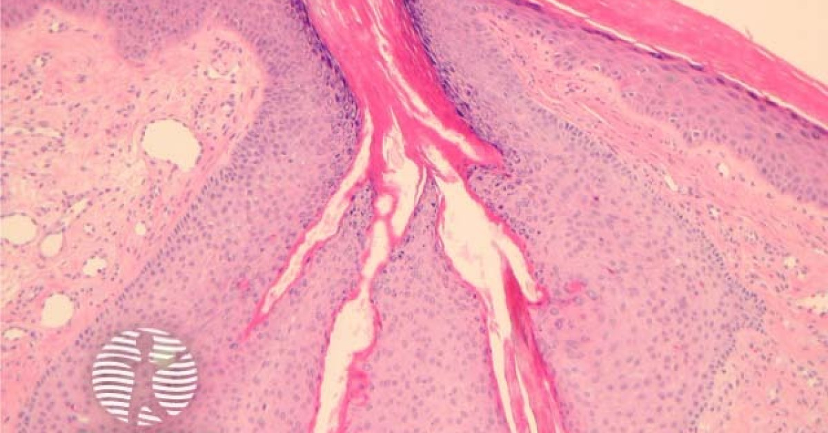 Trichofolliculoma / trichodiscoma pathology image