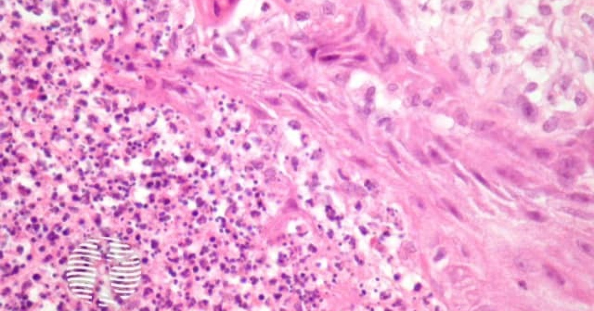 Cutaneous tuberculosis pathology image
