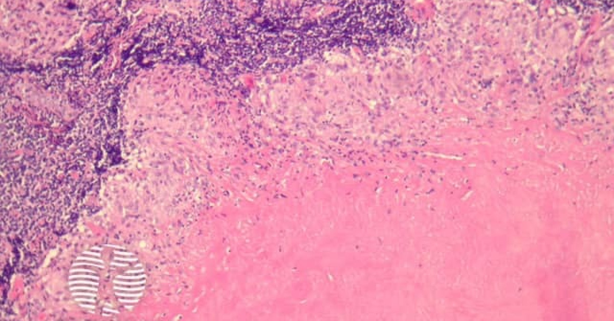 Cutaneous tuberculosis pathology image