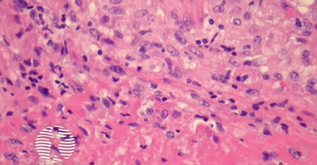 Cutaneous tuberculosis pathology image