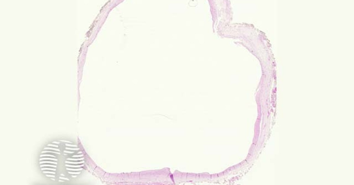 Urachal cyst pathology image
