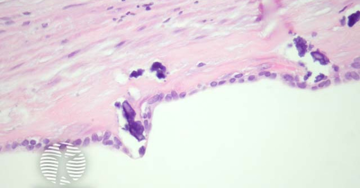 Urachal cyst pathology image