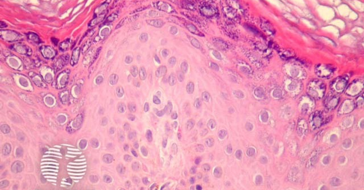 Verruca Plana Histopathology Verrucous Plaques On Sun Exposed Areas