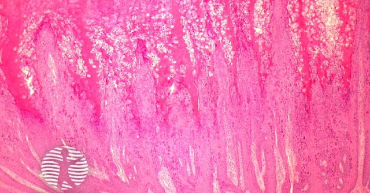 Verruca vulgaris pathology image