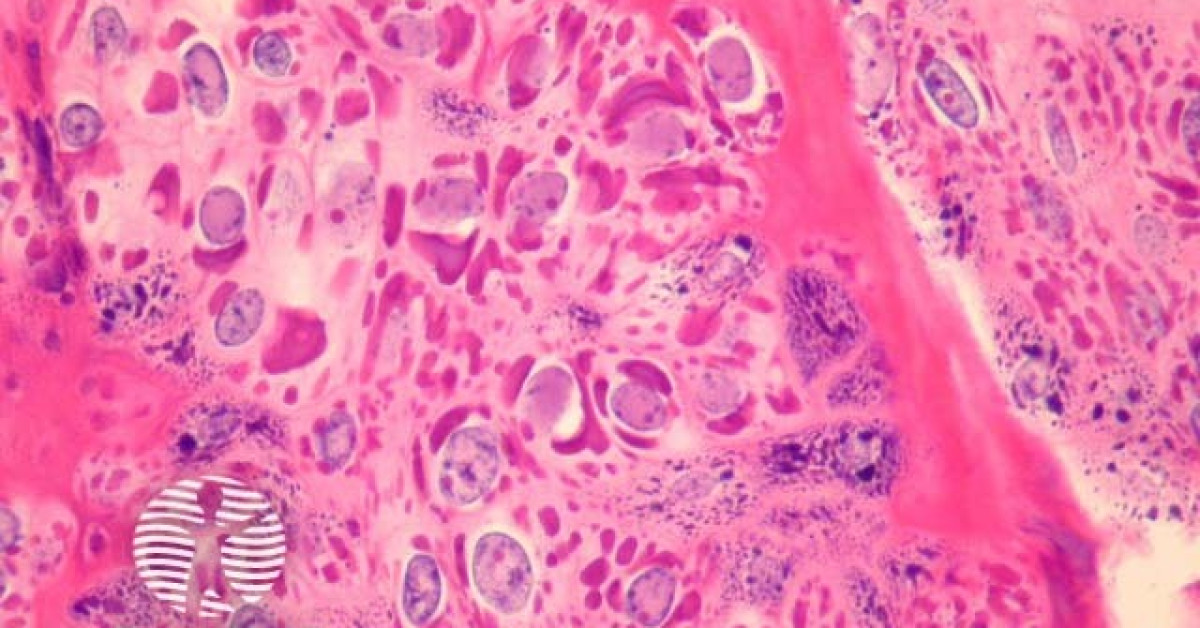 Verruca vulgaris pathology image