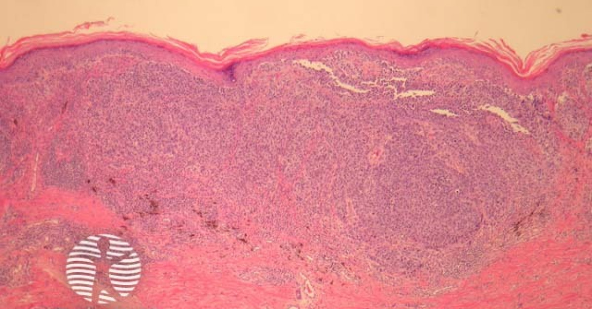 Melanoma pathology: superficial spreading melanoma, vertical growth ...