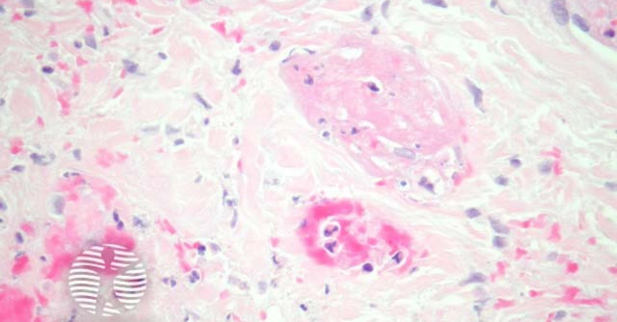 Warfarin necrosis pathology image