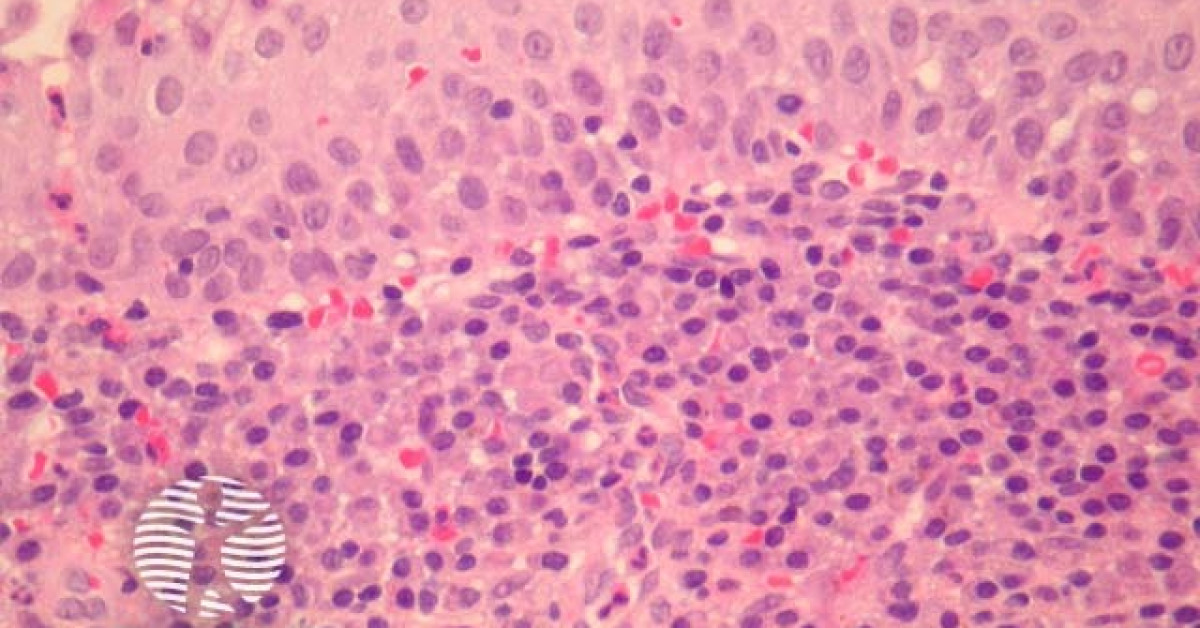 Zoon balanitis/vulvitis pathology image