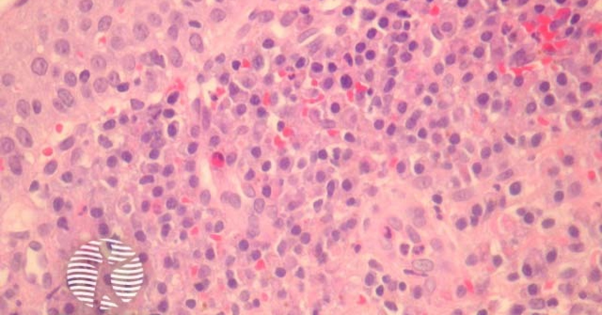 Zoon balanitis/vulvitis pathology image
